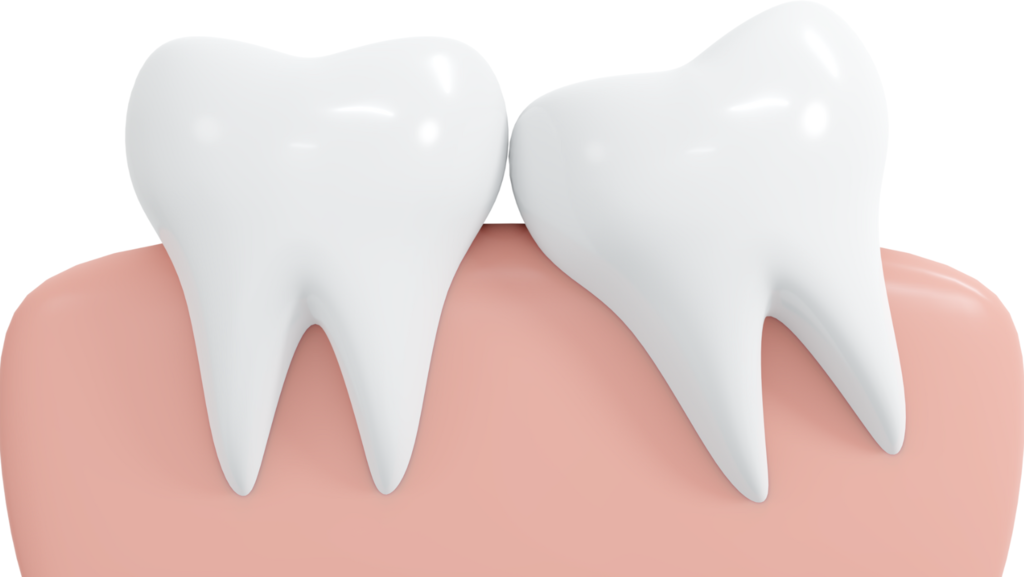 Wisdom Teeth | Dental Health Foundation